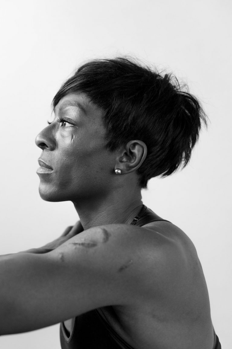 #PHOTOGRAPHY — ‘Behind The Scars’ ชุดภาพถ่ายที่บอกว่า ร่องรอย ตำหนิและ ...